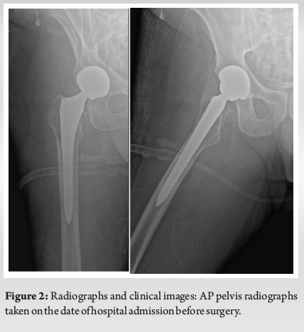 Short-term Success in Treatment of an Acute Hematogenous Periprosthetic ...
