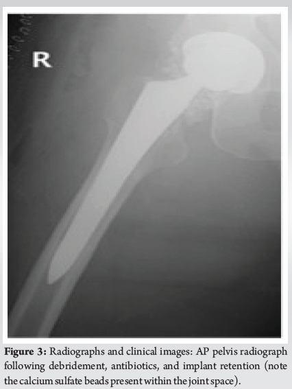 Short-term Success in Treatment of an Acute Hematogenous Periprosthetic ...