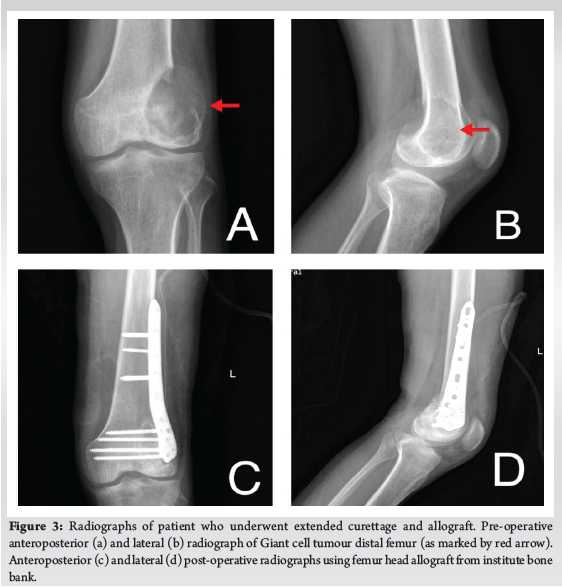 Functional Outcomes of Surgical Treatment for Giant Cell Tumors around ...
