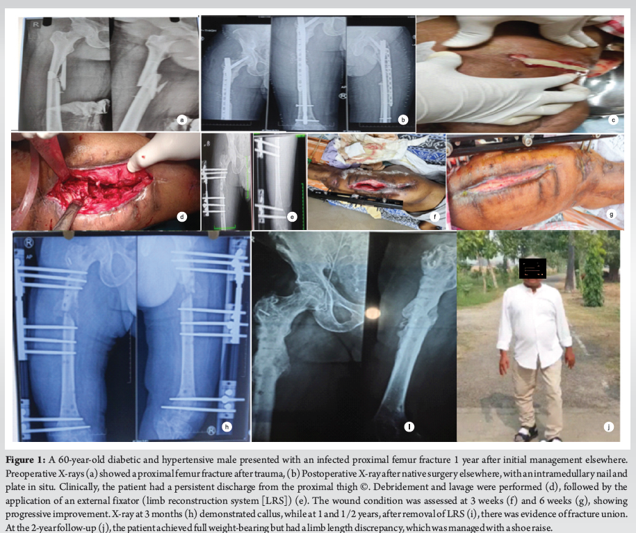 Limb Reconstruction System for Infected Nonunion: A Retrospective Study ...