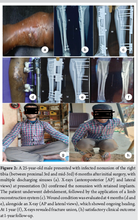 Limb Reconstruction System for Infected Nonunion: A Retrospective Study ...
