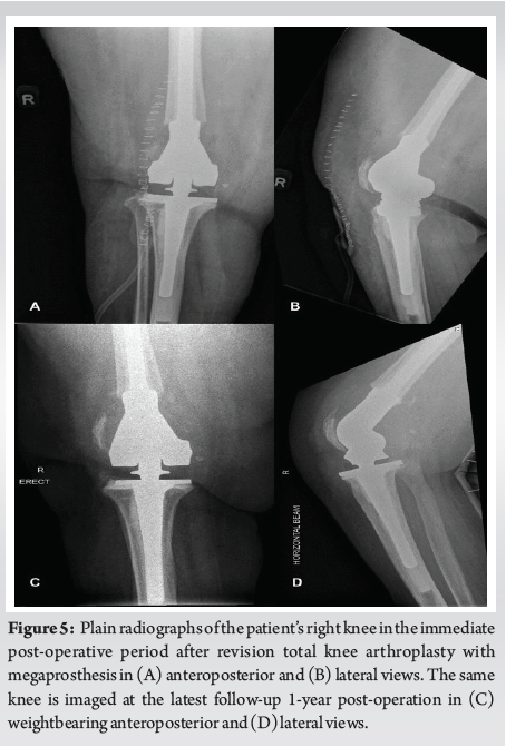 Concomitant Cement Spacer and Peri-spacer Fractures Seven Years After ...