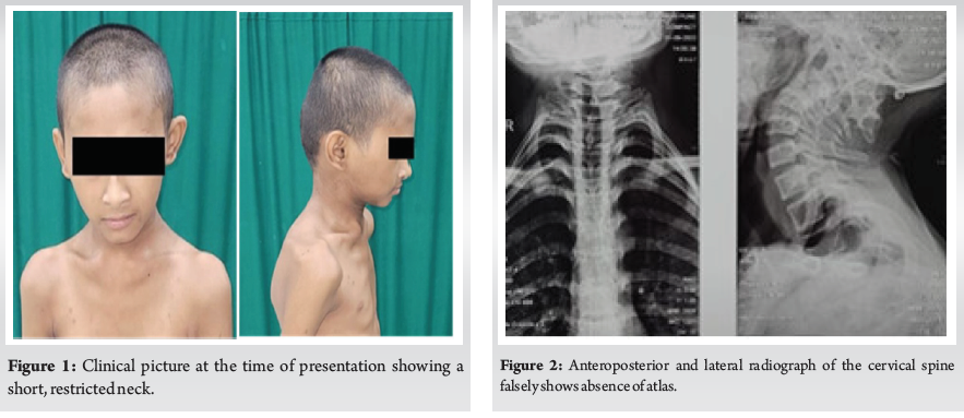 Atlanto-occipital Assimilation with Basilar Invagination and Atlanto ...