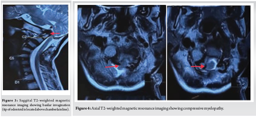 Atlanto-occipital Assimilation with Basilar Invagination and Atlanto ...