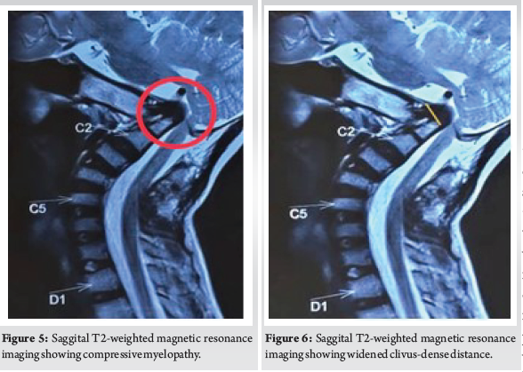 Atlanto-occipital Assimilation with Basilar Invagination and Atlanto ...