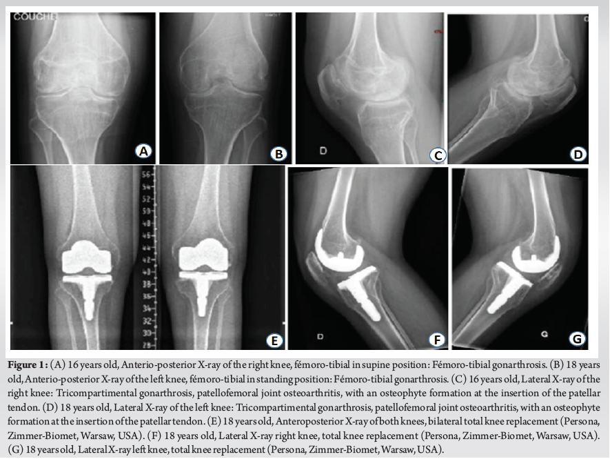 Multiple Joint Replacements for Progressive Pseudorheumatoid Dysplasia ...