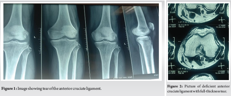 A Long-term Comparison of Outcome of Arthroscopic Anterior Cruciate ...
