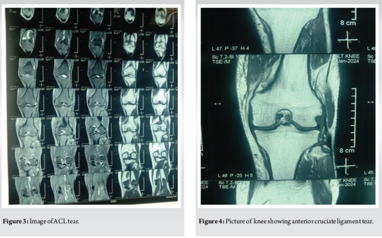 A Long-term Comparison of Outcome of Arthroscopic Anterior Cruciate ...