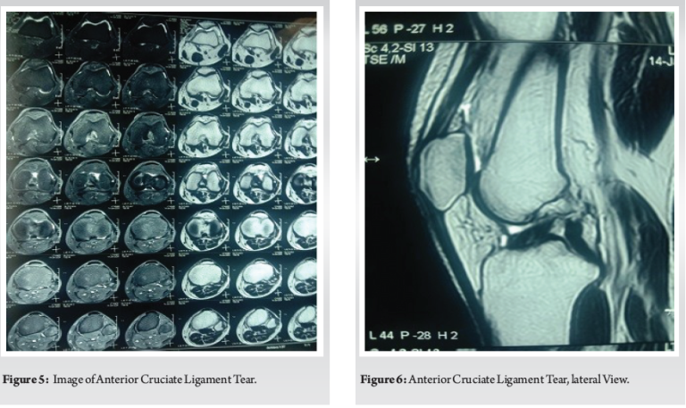A Long-term Comparison of Outcome of Arthroscopic Anterior Cruciate ...