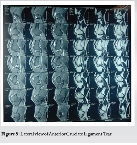 A Long-term Comparison of Outcome of Arthroscopic Anterior Cruciate ...