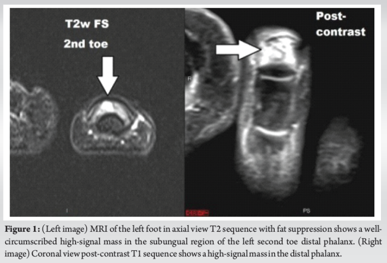 Glomus Tumor of the Left Second Toe Distal Phalanx: A Case Report and ...