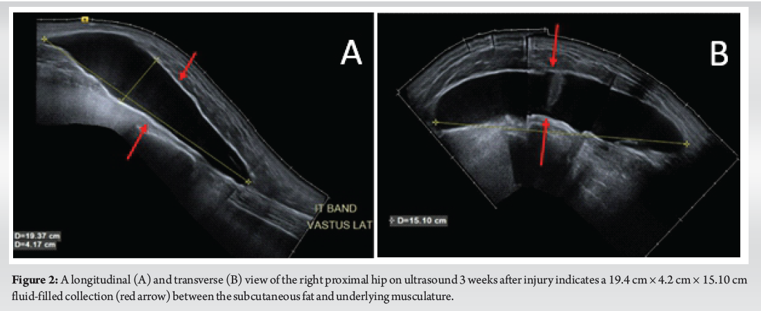 Surgical Management of Chronic Morel-Lavallée Lesion with Minimal ...