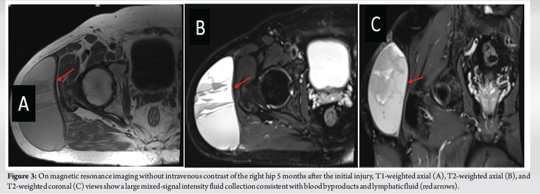 Surgical Management of Chronic Morel-Lavallée Lesion with Minimal ...