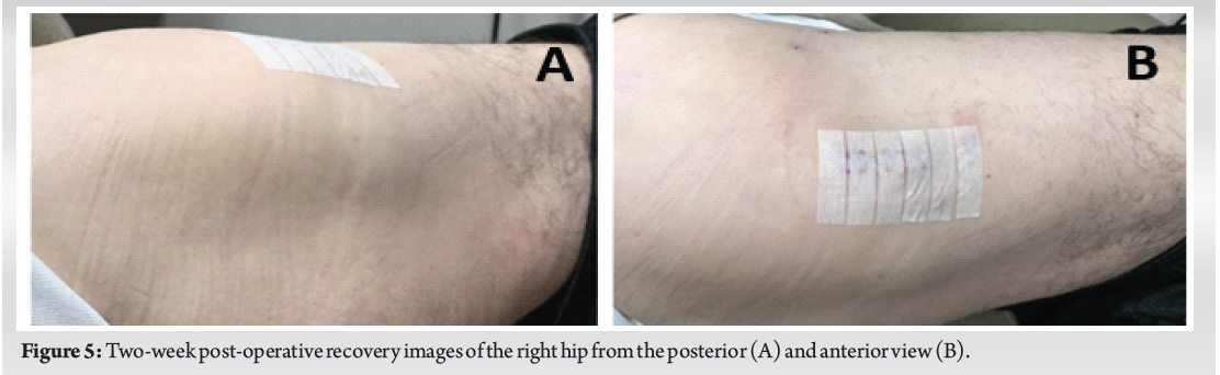 Surgical Management of Chronic Morel-Lavallée Lesion with Minimal ...