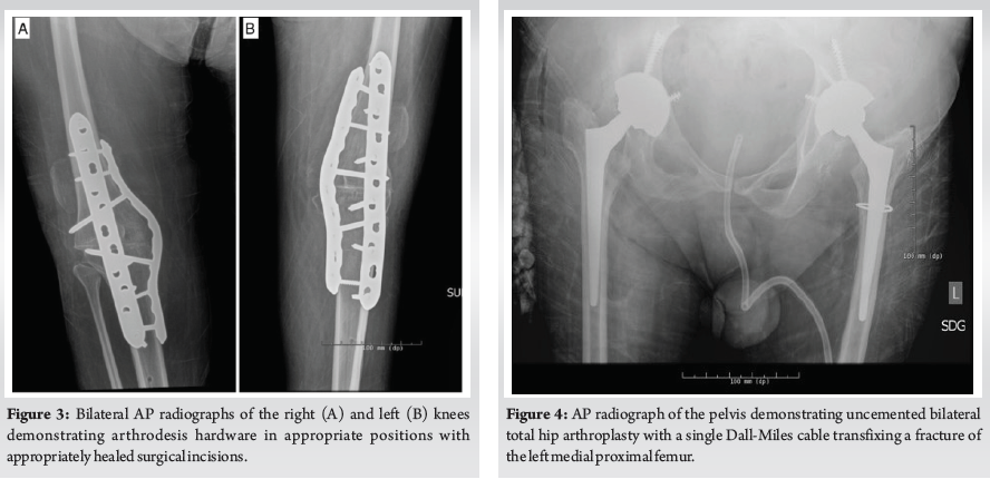Bilateral Knee Arthrodesis and Total Hip Arthroplasty for Knee and Hip ...