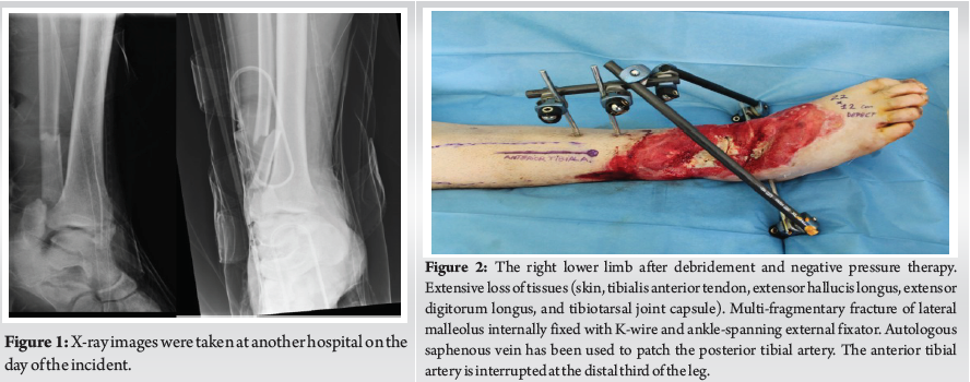 Lower-Limb Salvage Procedure using Anterolateral Thigh Free Flap and ...