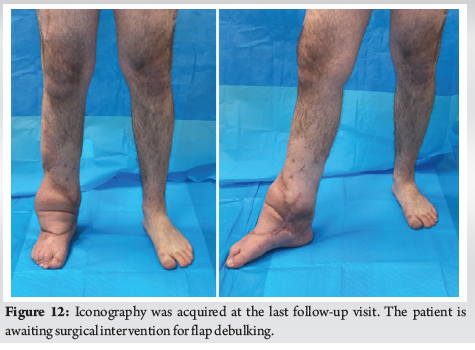Lower-Limb Salvage Procedure using Anterolateral Thigh Free Flap and ...