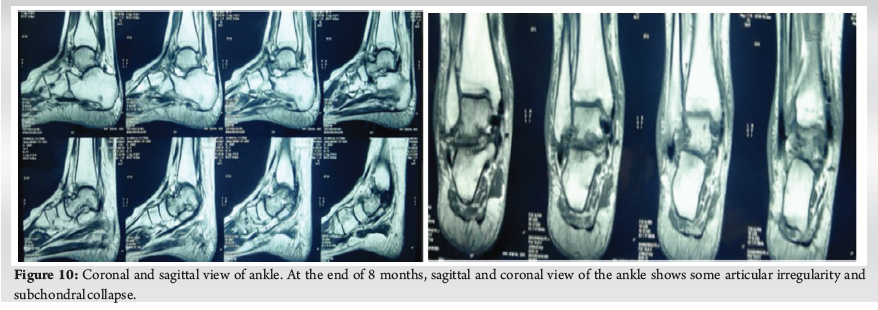 Early Reimplantation of Open Total Extruded Talus: A Case Report ...