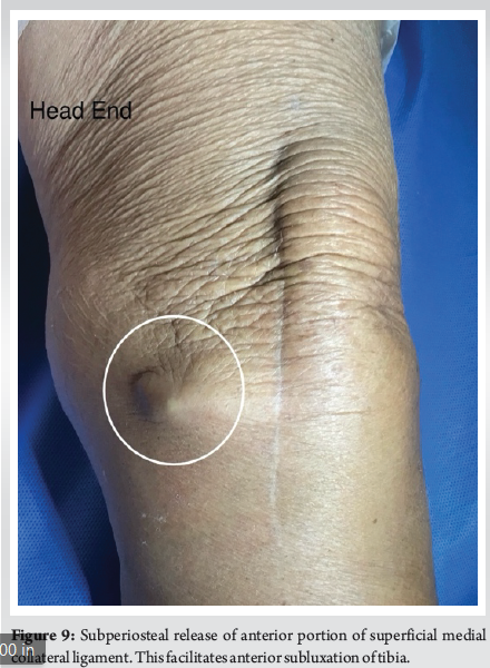 Unusual Case of Failure of Tibial Polyethylene Insert Locking Mechanism ...