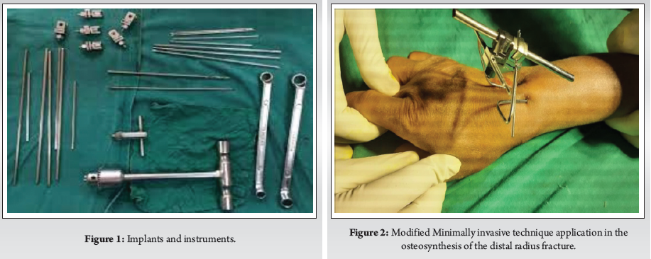 Modified Minimally Invasive Reduction and Osteosynthesis System ...