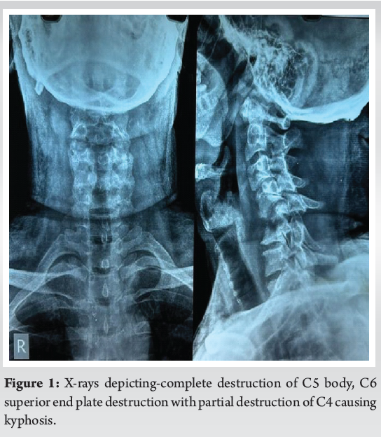 Infective Spondylodiscitis of Unknown Origin in a Patient with Chronic ...