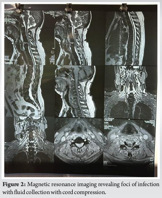 Infective Spondylodiscitis of Unknown Origin in a Patient with Chronic ...