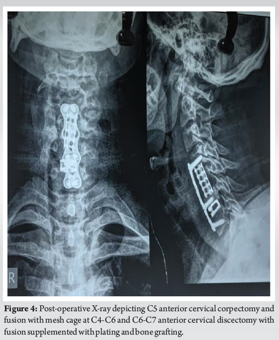 Infective Spondylodiscitis of Unknown Origin in a Patient with Chronic ...