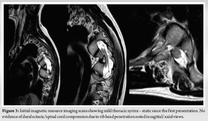 Myelopathy Associated with Rapid Progression of a Dystrophic ...