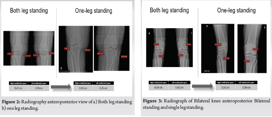Single Stance Radiography of the Knee Joint – A Novel Approach to ...