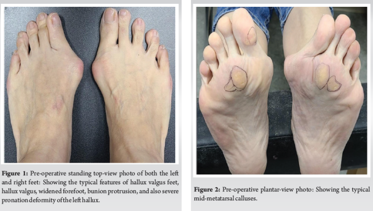 Spontaneous First Metatarsal Rotational Correction by the Syndesmosis ...