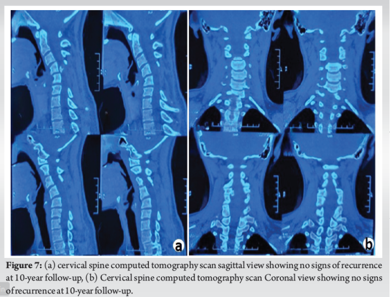 Spinal Enchondromas in the Cervical Spine: Rarity, Recurrence and the ...