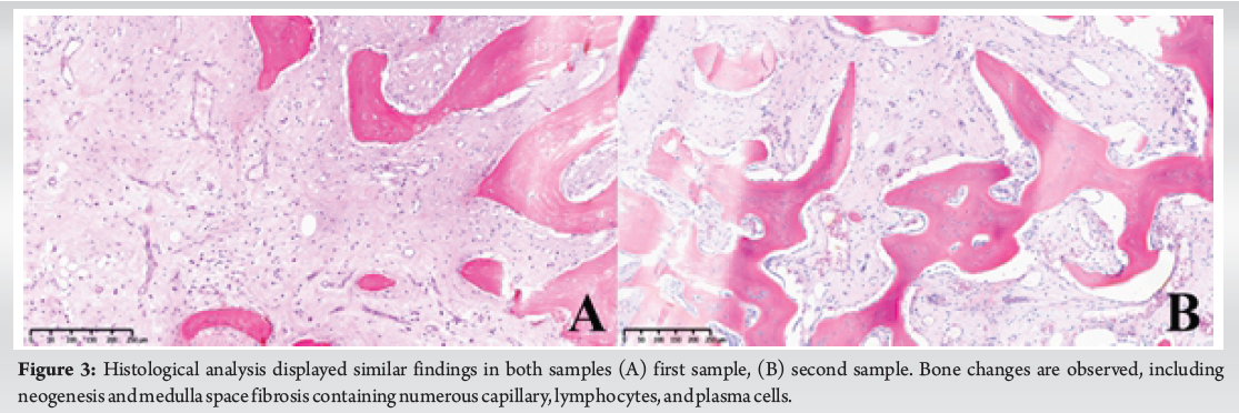 Spontaneous Clavicular Osteomyelitis Caused by Cutibacterium acnes ...