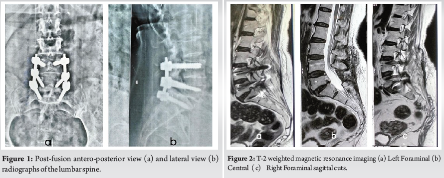Recurrent Radiculopathy Following Transforaminal Lumbar Interbody ...
