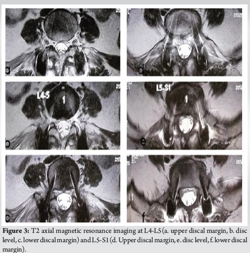 Recurrent Radiculopathy Following Transforaminal Lumbar Interbody ...