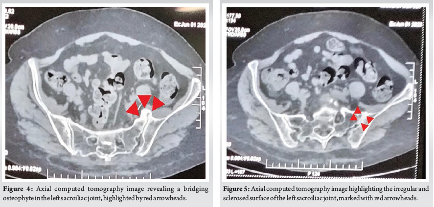 Recurrent Radiculopathy Following Transforaminal Lumbar Interbody ...