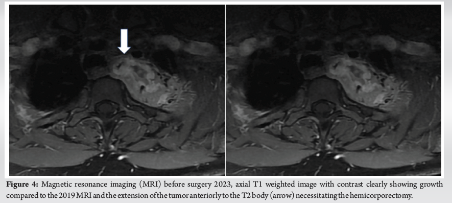Case Report of a Hemangioblastoma Originating from the T1 Spinal Nerve ...