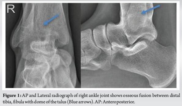 Complete Ankle Joint that is Tibiotalar and Distal Tibiofibular ...