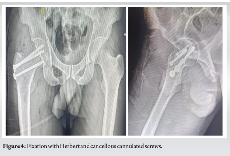 Case Report of a Delayed Rare Pipkin Type III Fracture in Adult Male ...