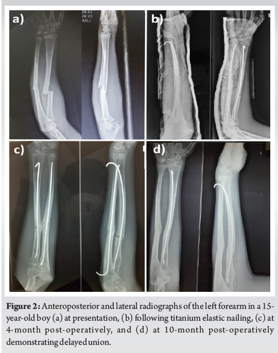 Pediatric Forearm Fractures: Investigating the Functional Outcomes of Titanium Elastic Nailing ...