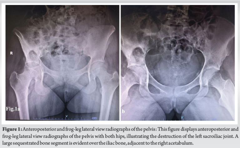 Multifocal Skeletal Tuberculosis – A Case Report | Journal of ...
