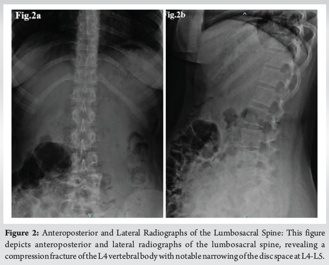 Multifocal Skeletal Tuberculosis – A Case Report | Journal of ...