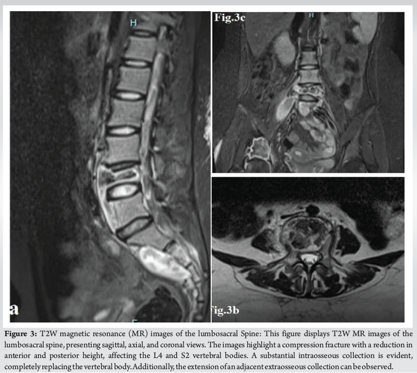 Multifocal Skeletal Tuberculosis – A Case Report | Journal of ...