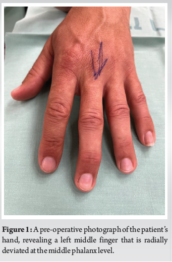 Minimally Invasive Corrective Osteotomy (MICO) of the Hand a Novel ...