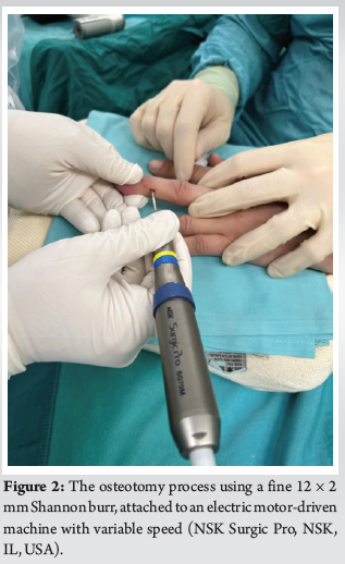 Minimally Invasive Corrective Osteotomy (MICO) of the Hand a Novel ...