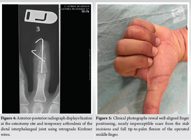 Minimally Invasive Corrective Osteotomy (MICO) of the Hand a Novel ...