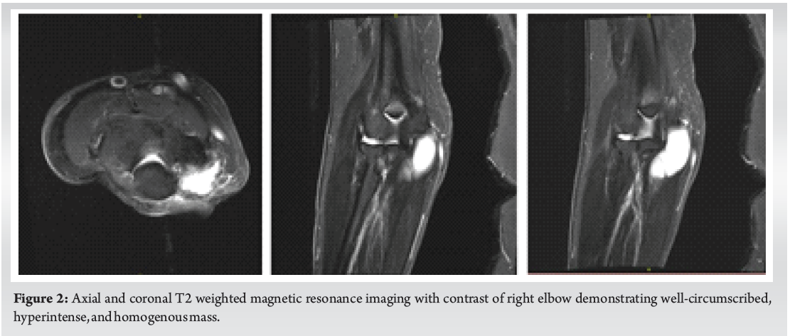 Intramuscular Myxoma of the Flexor Carpi Ulnaris Causing Cubital Tunnel ...