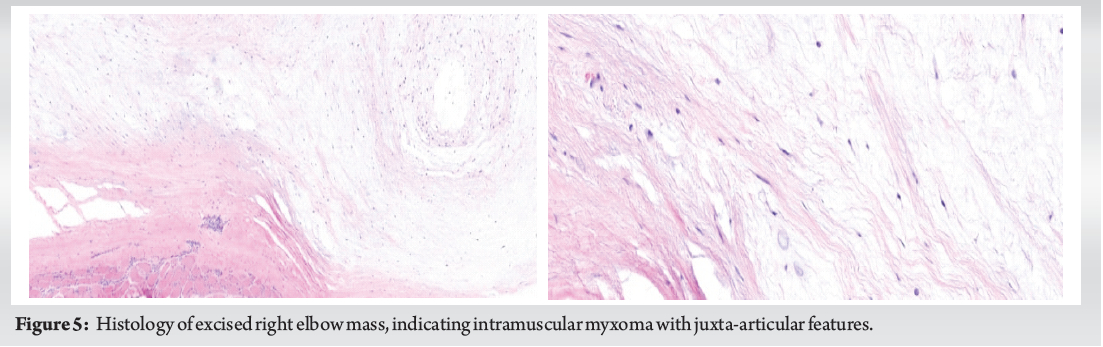 Intramuscular Myxoma of the Flexor Carpi Ulnaris Causing Cubital Tunnel ...