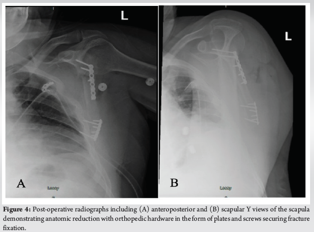 Traumatic Scapula Fracture with Intrathoracic Interposition: A Case ...