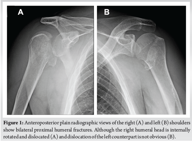 Difficulty in Early Diagnosis of Bilateral Posterior Fracture ...