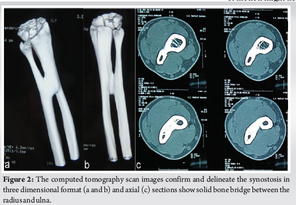 Post-Traumatic Radio-ulnar Synostosis Managed by the Excision of the ...